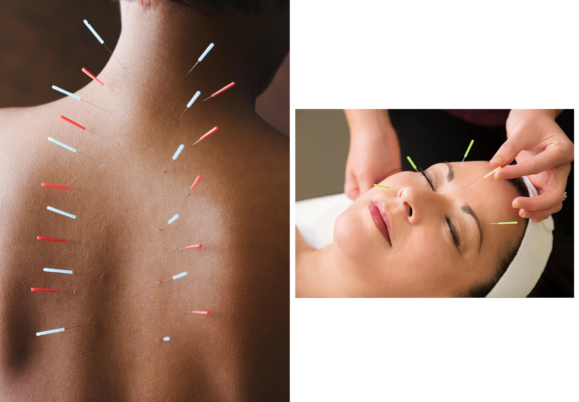 Acupuncture: Ancient energy, modern benefits for health and beauty ...
